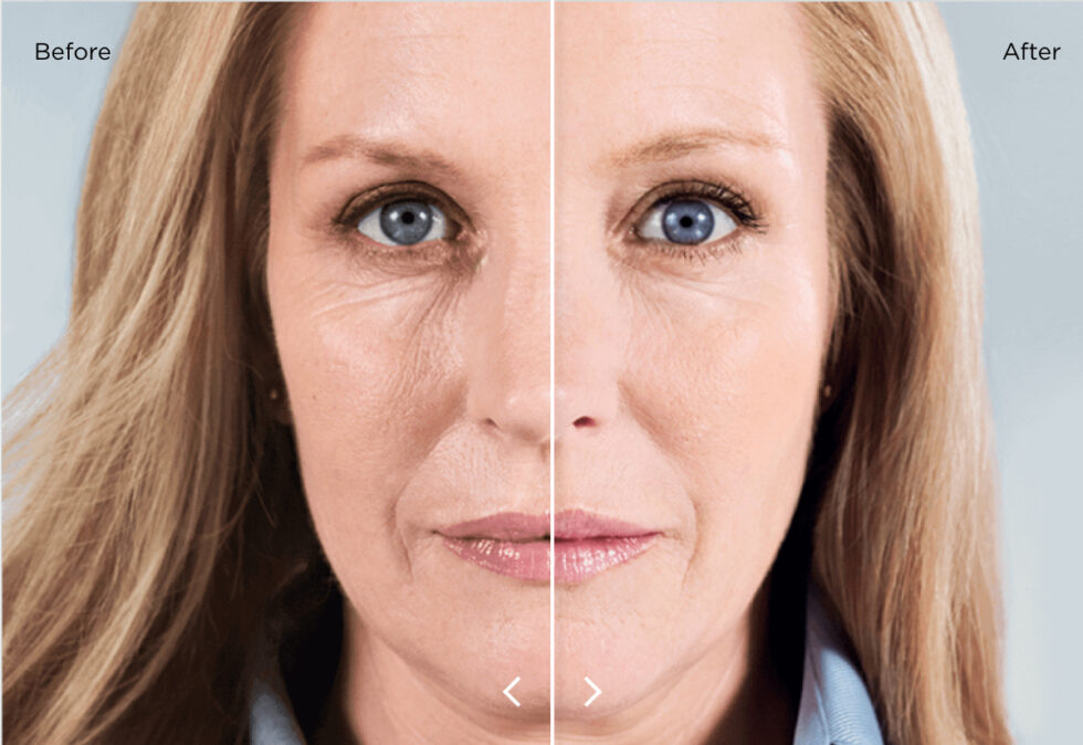 Austin TX Botox | Sculptra BBL - BodyBrite Austin